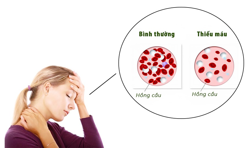 Ở Đây Bán Thuốc - Bệnh thiếu máu